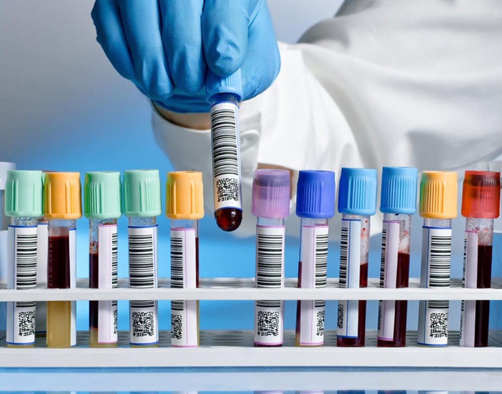 Alkaline Phosphatase در آزمایش خون چیست؟ + تفسیر آزمایش آلکالین فسفاتاز ...